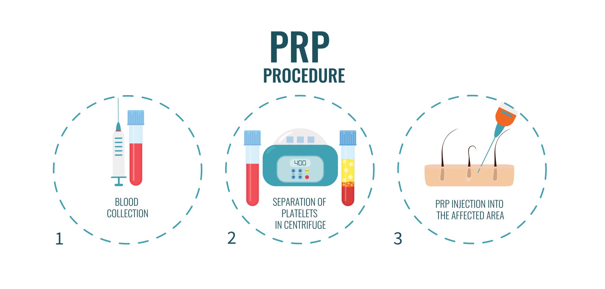 Why Is PRP Beneficial at the Same Time as Hair Transplant Surgery ...