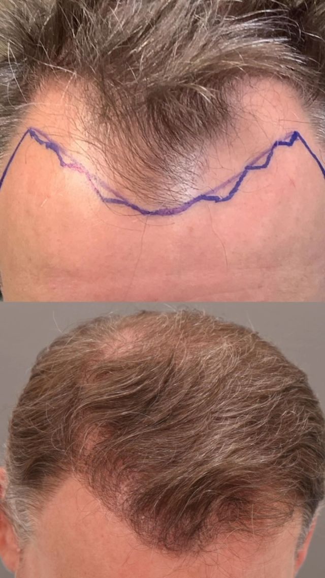 Surgical & Nonsurgical Hair Restoration Rochester, Buffalo & Syracuse ...